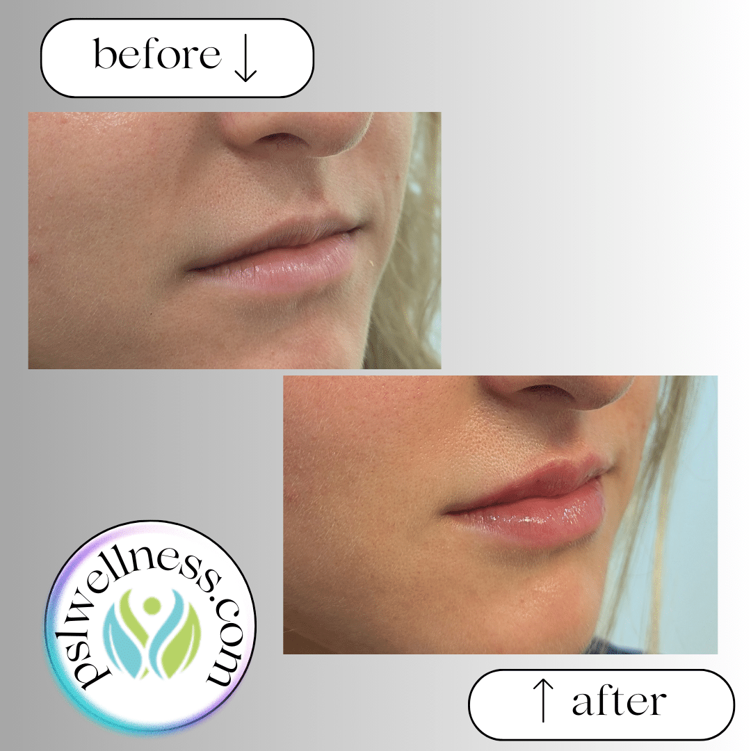 Lip Filler - Port St. Lucie Medical Wellness 3033