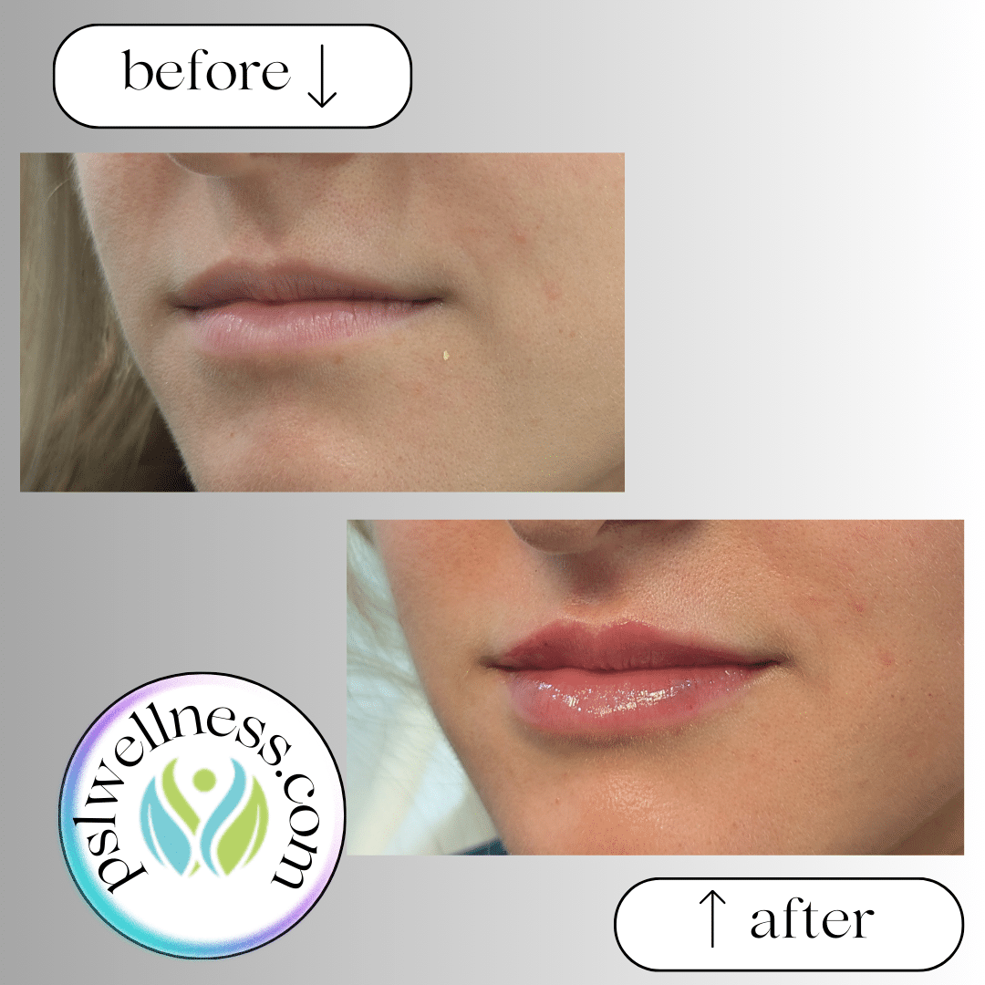 Lip Filler - Port St. Lucie Medical Wellness 3033