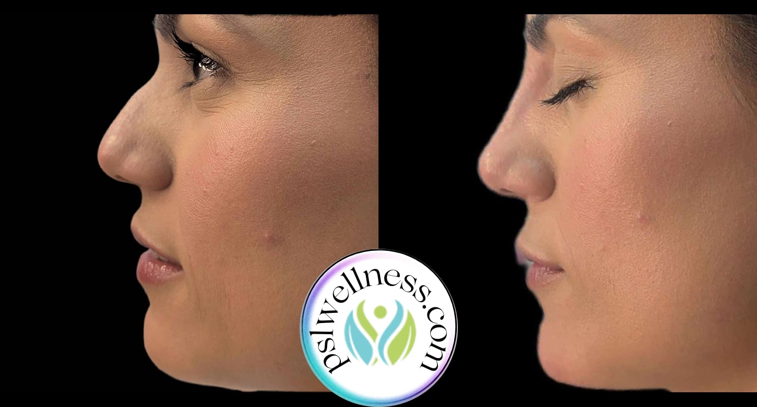 Liquid Rhinoplasty - Port St. Lucie Medical Wellness 3025