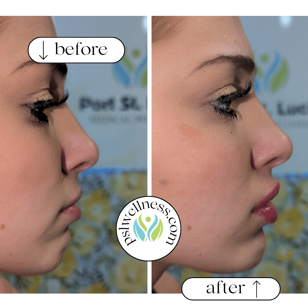 Facial Balancing with Chin & Lip Filler - Port St. Lucie